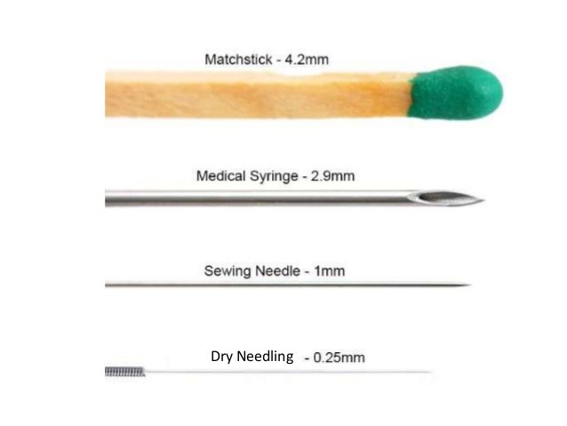 What is Dry Needling? – Ascend Performance Therapy